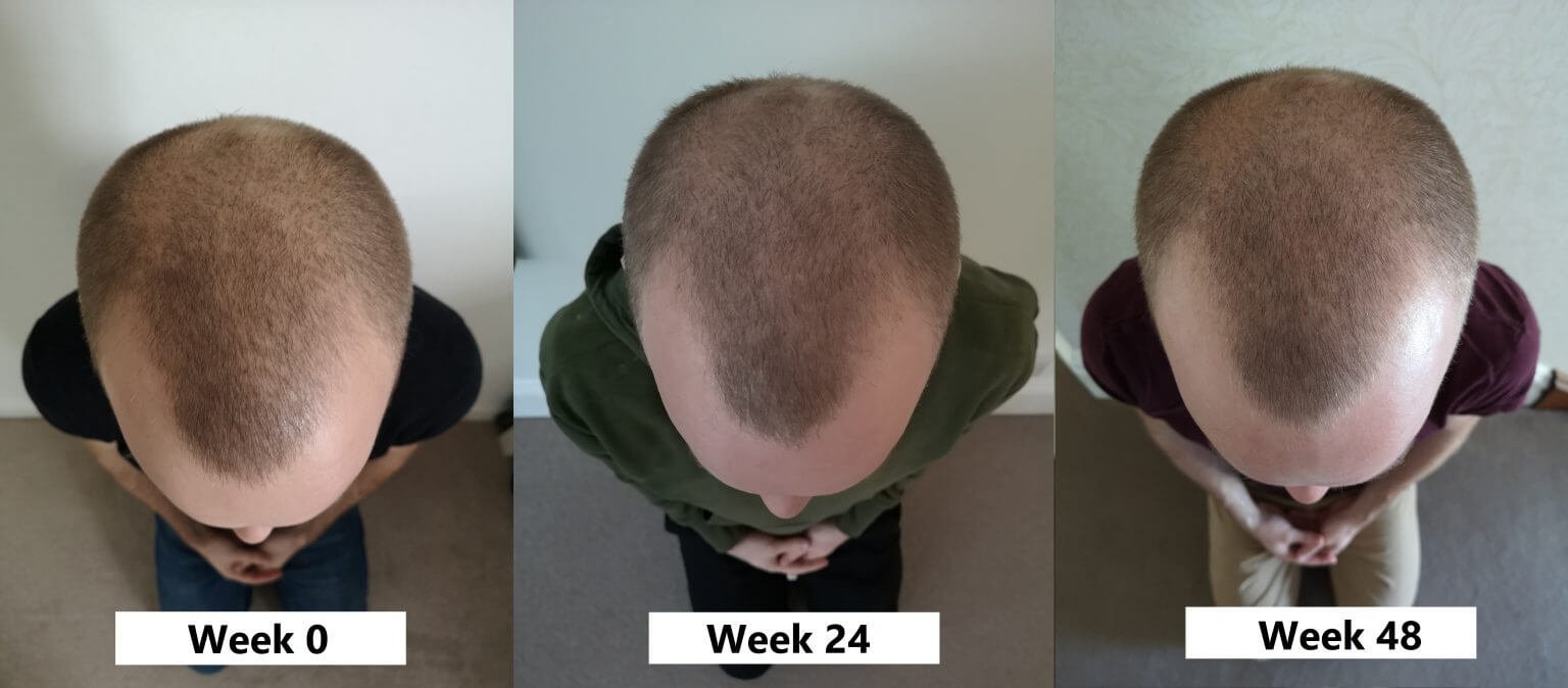 Hair Regrowth Self Experiments