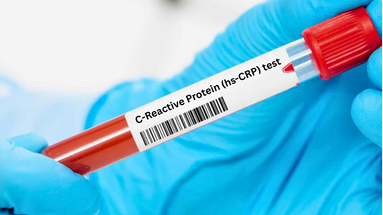 How To Measure Inflammation With A CRP Blood Test